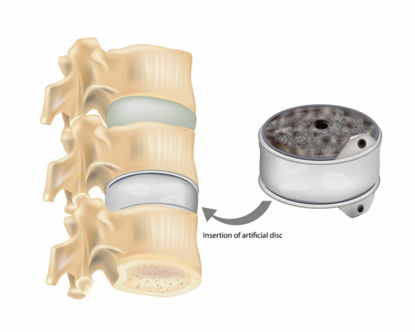 Lumbar Disc Replacement - Minimally Invasive Treatment Option