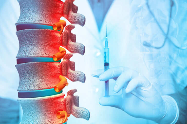 Medial Branch Blocks - Minimally Invasive Pain Management - TSO