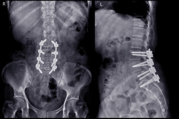 Failed Back Surgery Syndrome - Total Spine and Orthopedics