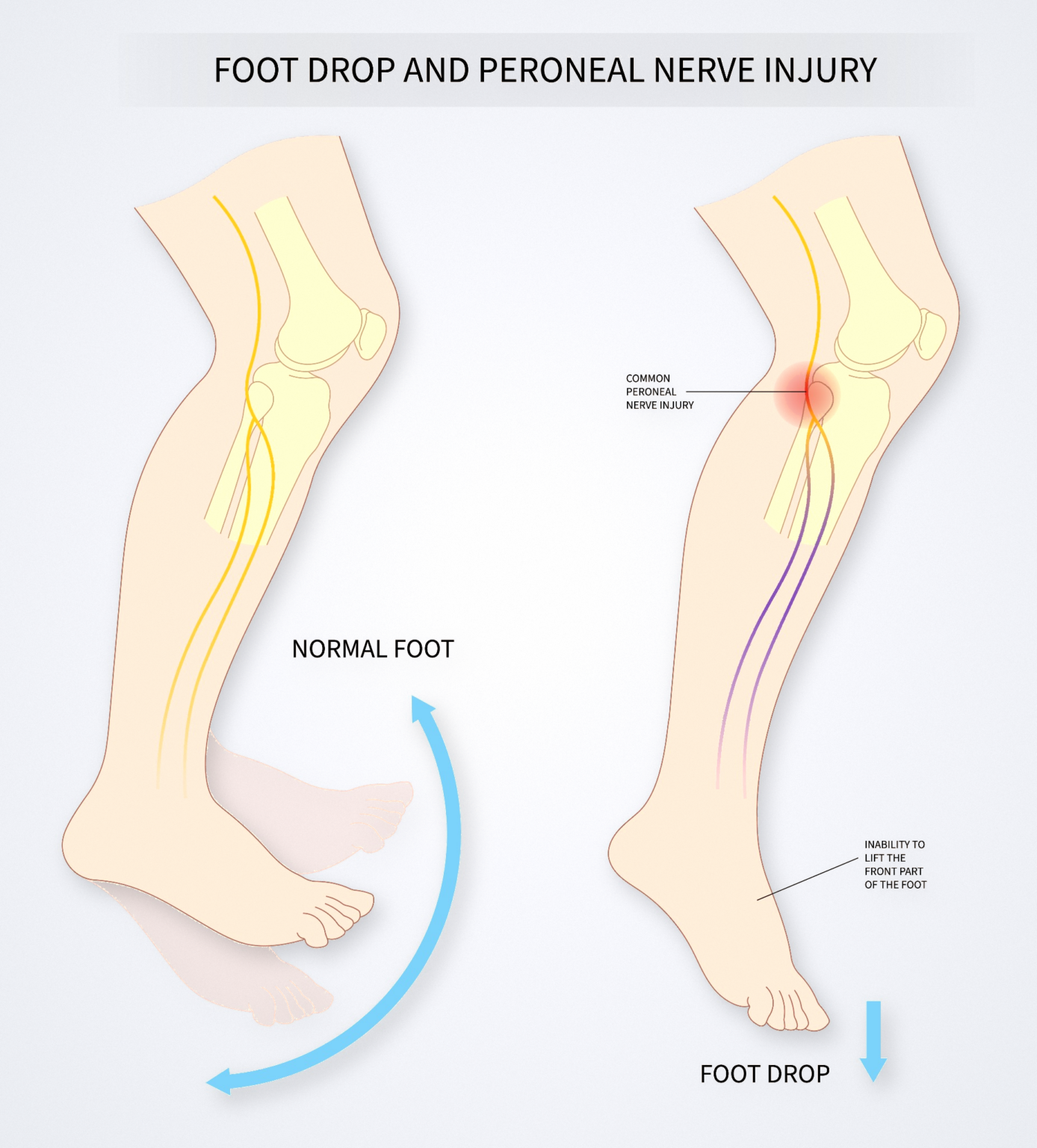Drop Foot Symptoms and Treatments - Total Spine and Orthopedics