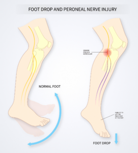 Drop Foot Symptoms and Treatments - Total Spine and Orthopedics