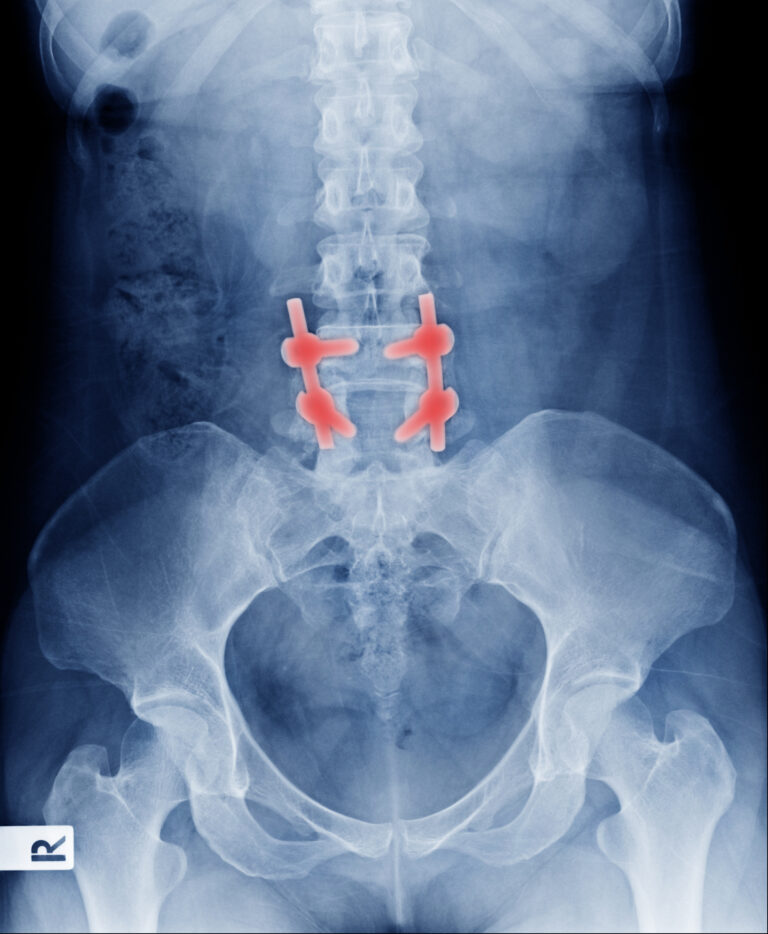 Transforaminal Lumbar Interbody Fusion (TLIF) - Total Spine