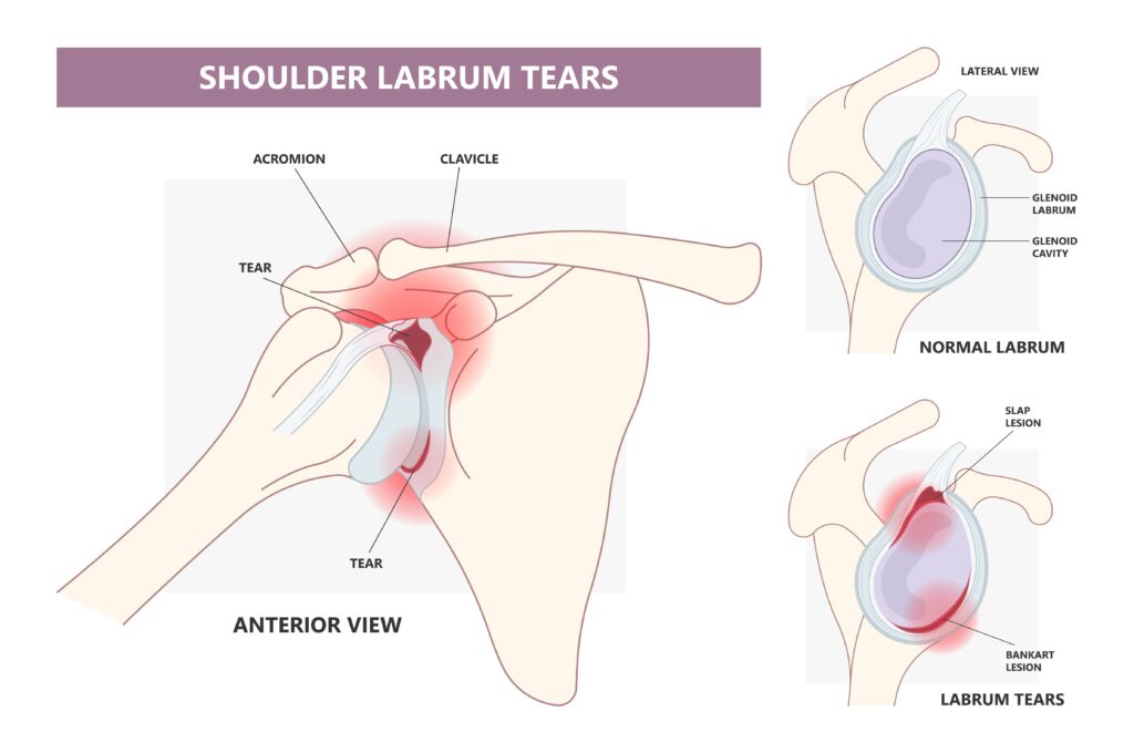 Shoulder Labral Tears - Total Spine and Orthopedics