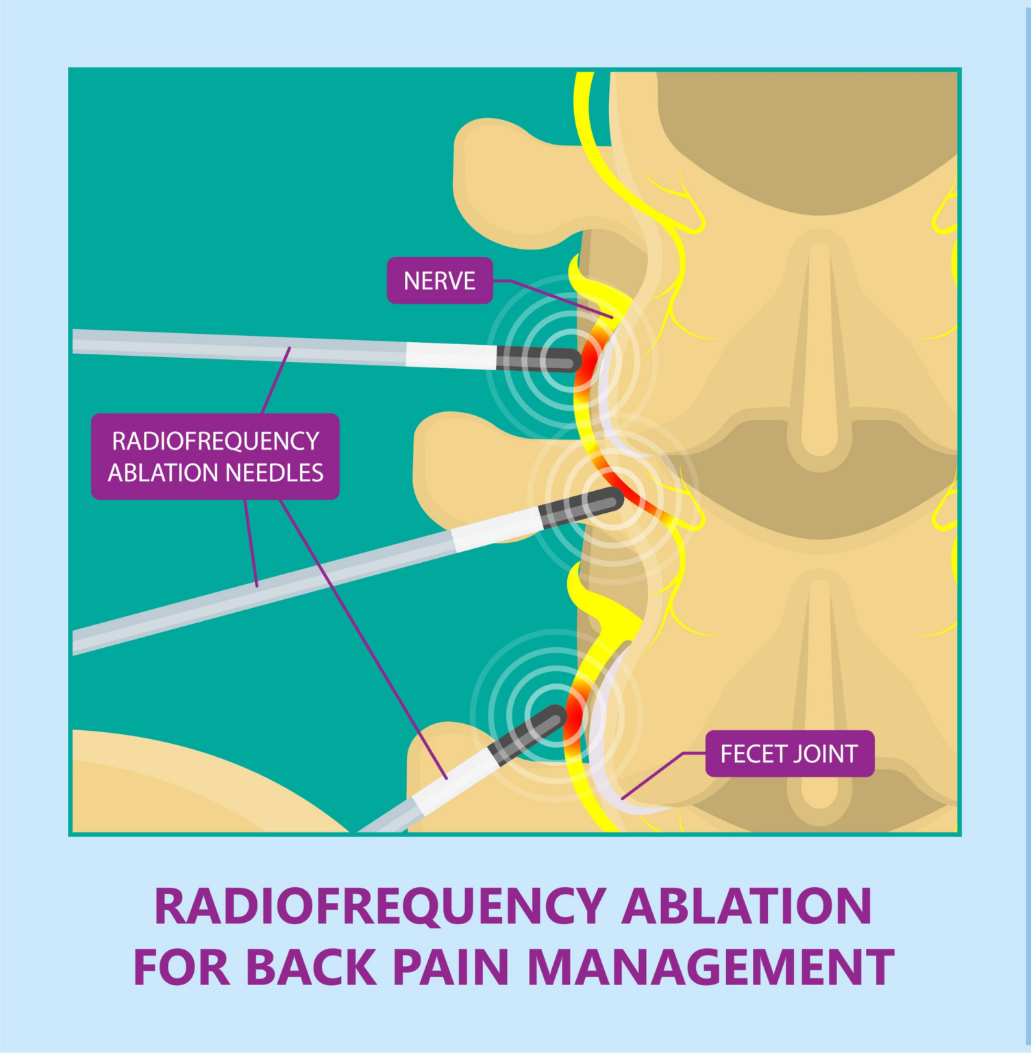 Radiofrequency Ablation (RFA) - Minimally Invasive - Total Spine