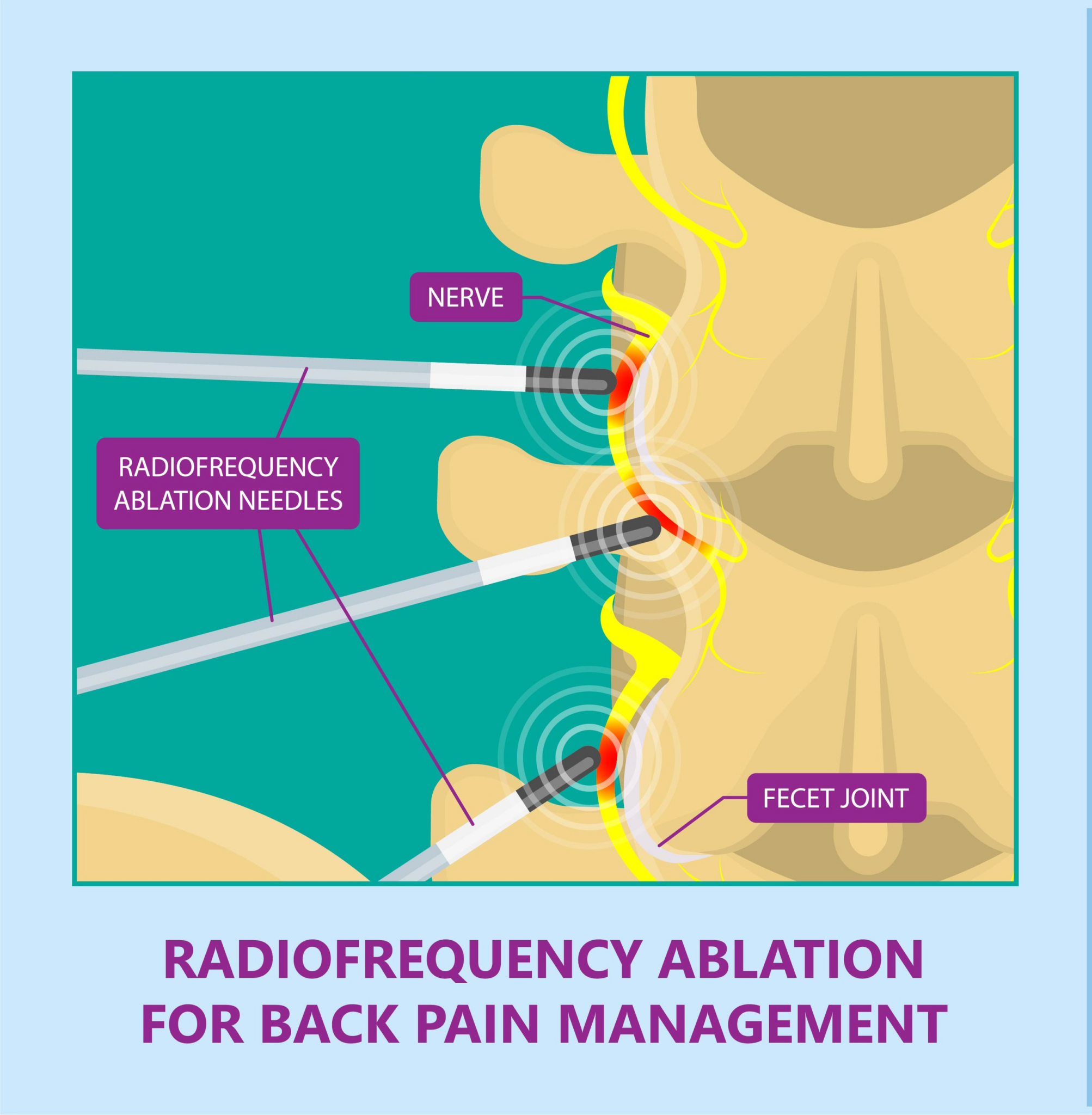 Radiofrequency Ablation (RFA) - Minimally Invasive - Total Spine