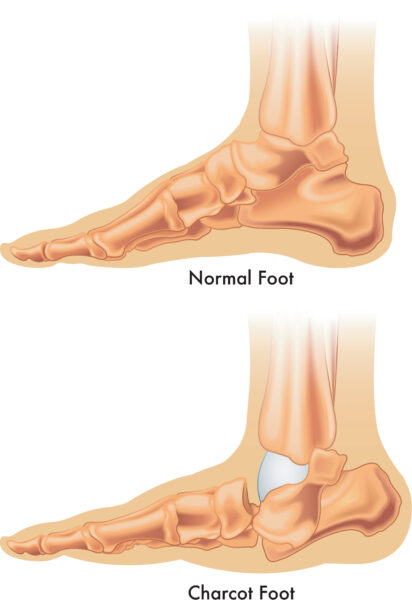 Charcot Foot Reconstruction Surgery | Treatment & Recovery