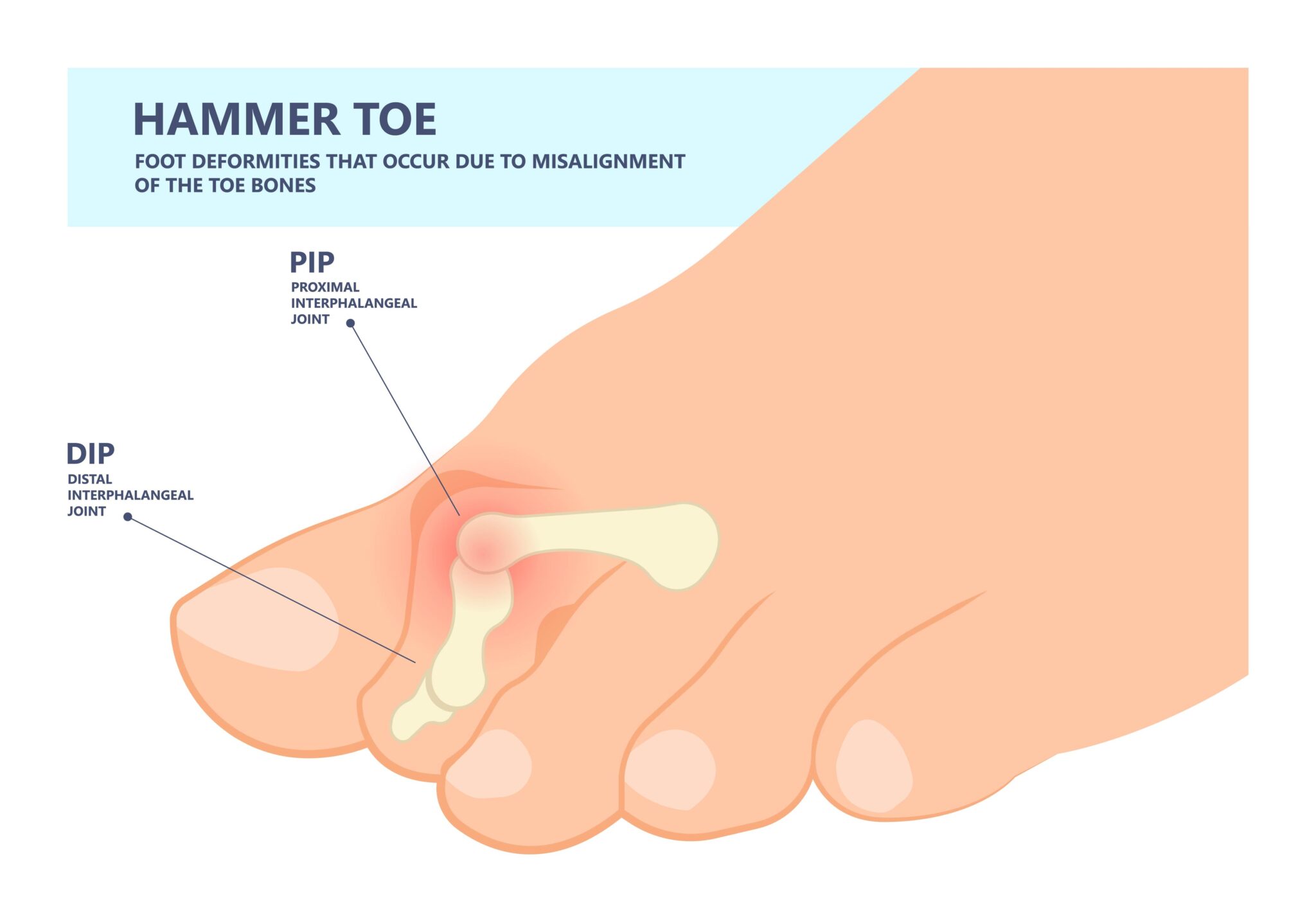 Minimally Invasive Hammertoe and Toe Deformity Correction