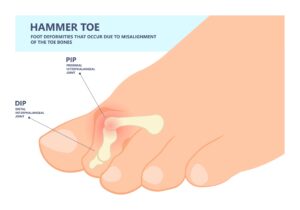 Minimally Invasive Hammertoe and Toe Deformity Correction