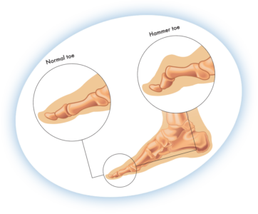 Minimally Invasive Hammertoe and Toe Deformity Correction